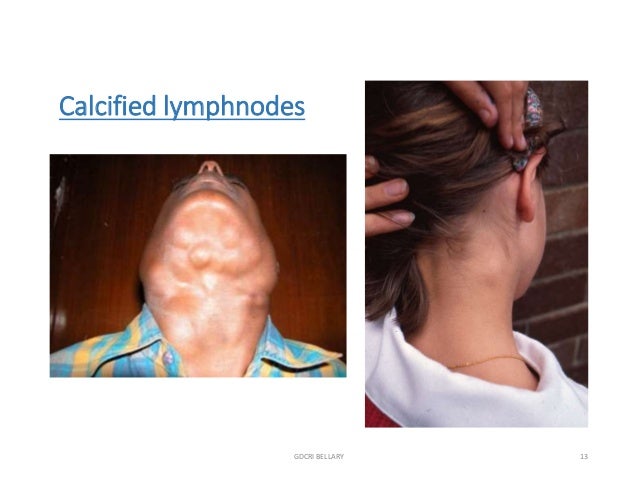 abnormal calcifications in head and neck region also with oral tissue…