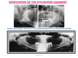 abnormal calcifications in head and neck region also with oral tissues ...
