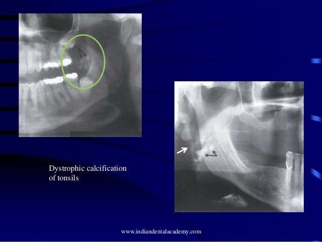 Soft tissue calcifications and ossifications / oral surgery courses
