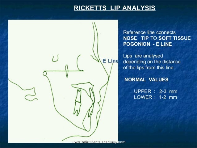 Soft tissue cephalometric analysis /certified fixed orthodontic cours…