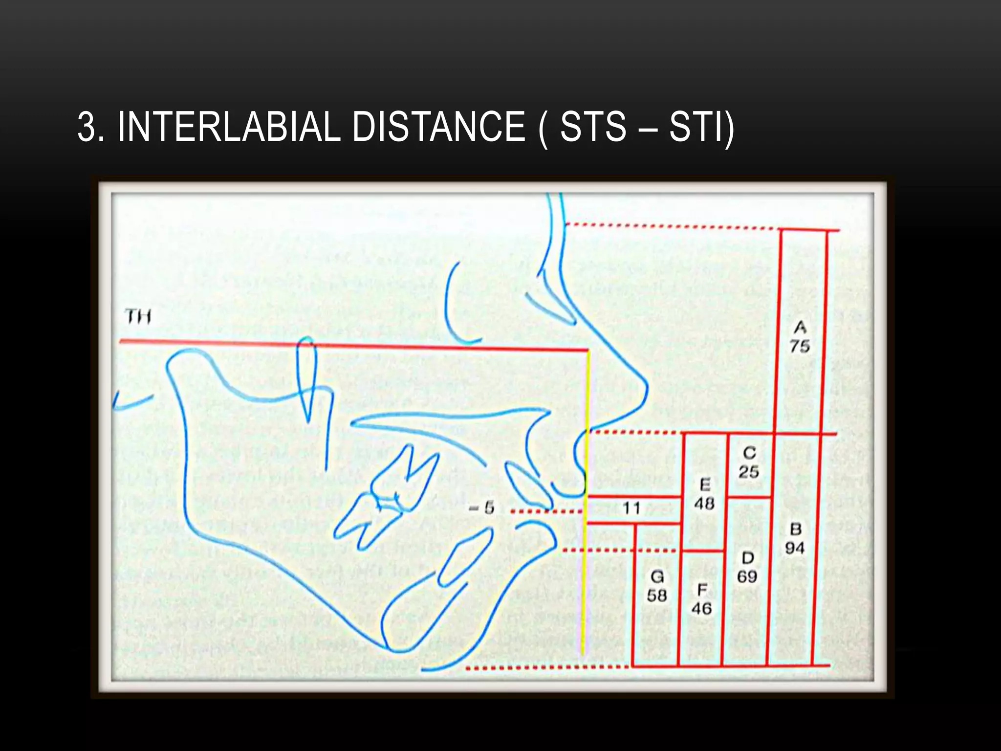 Soft tissue cephalometric analysis for orthognathic surgery | PPTX