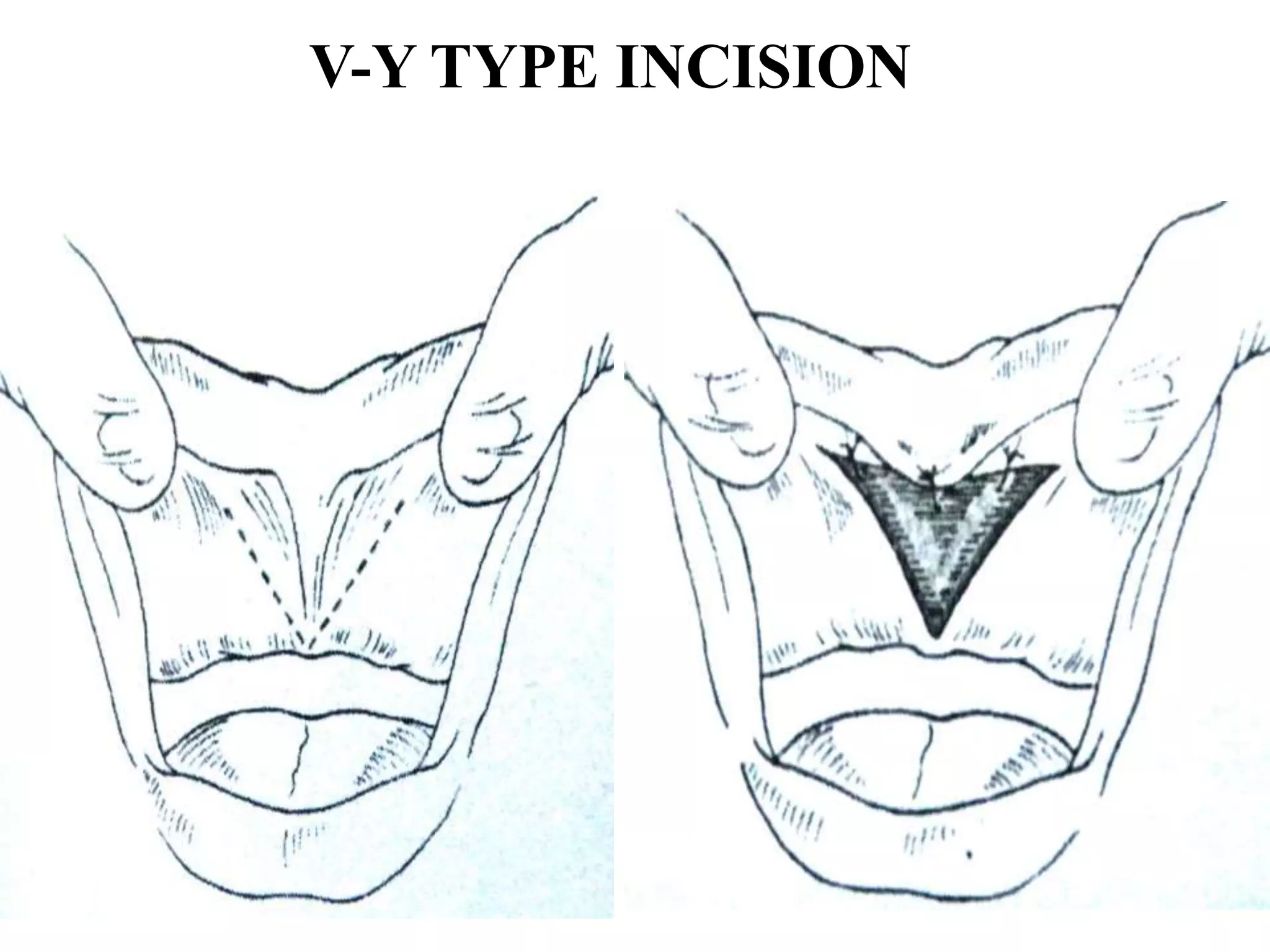 Soft tissue changes in preprosthetic surgery | PPTX
