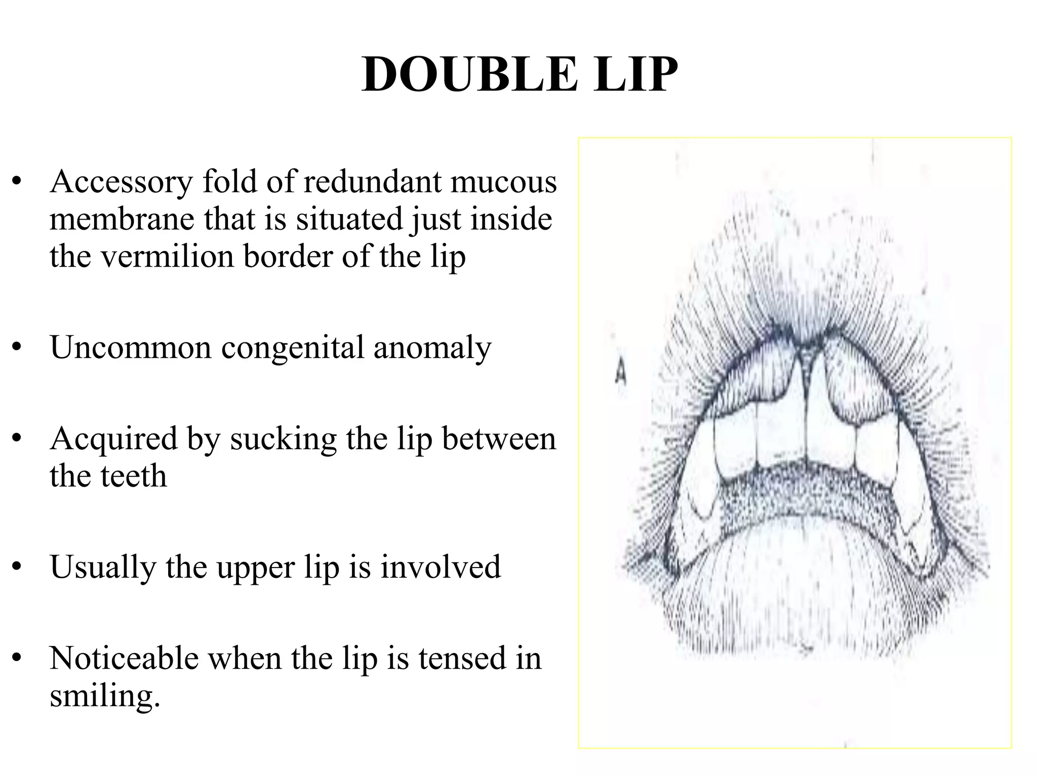Soft tissue changes in preprosthetic surgery | PPTX