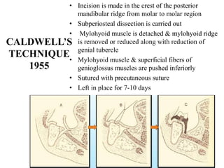 Mylohyoid Ridge Reduction