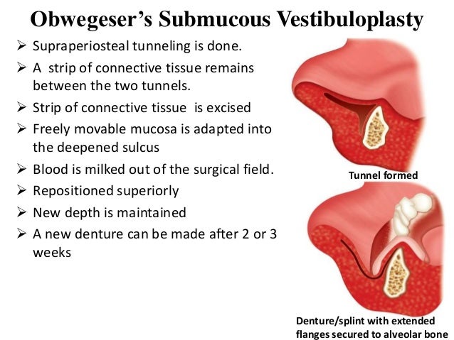Soft tissue changes in preprosthetic surgery