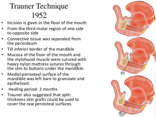 Soft tissue changes in preprosthetic surgery