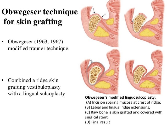 Soft tissue changes in preprosthetic surgery