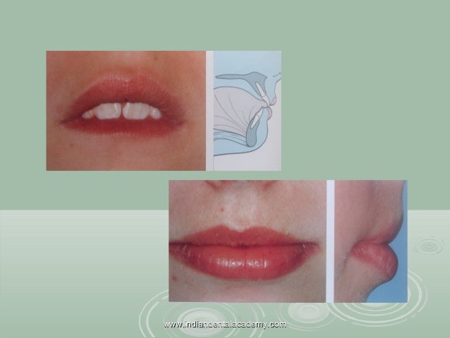 Soft tissue consideration in orthodontics