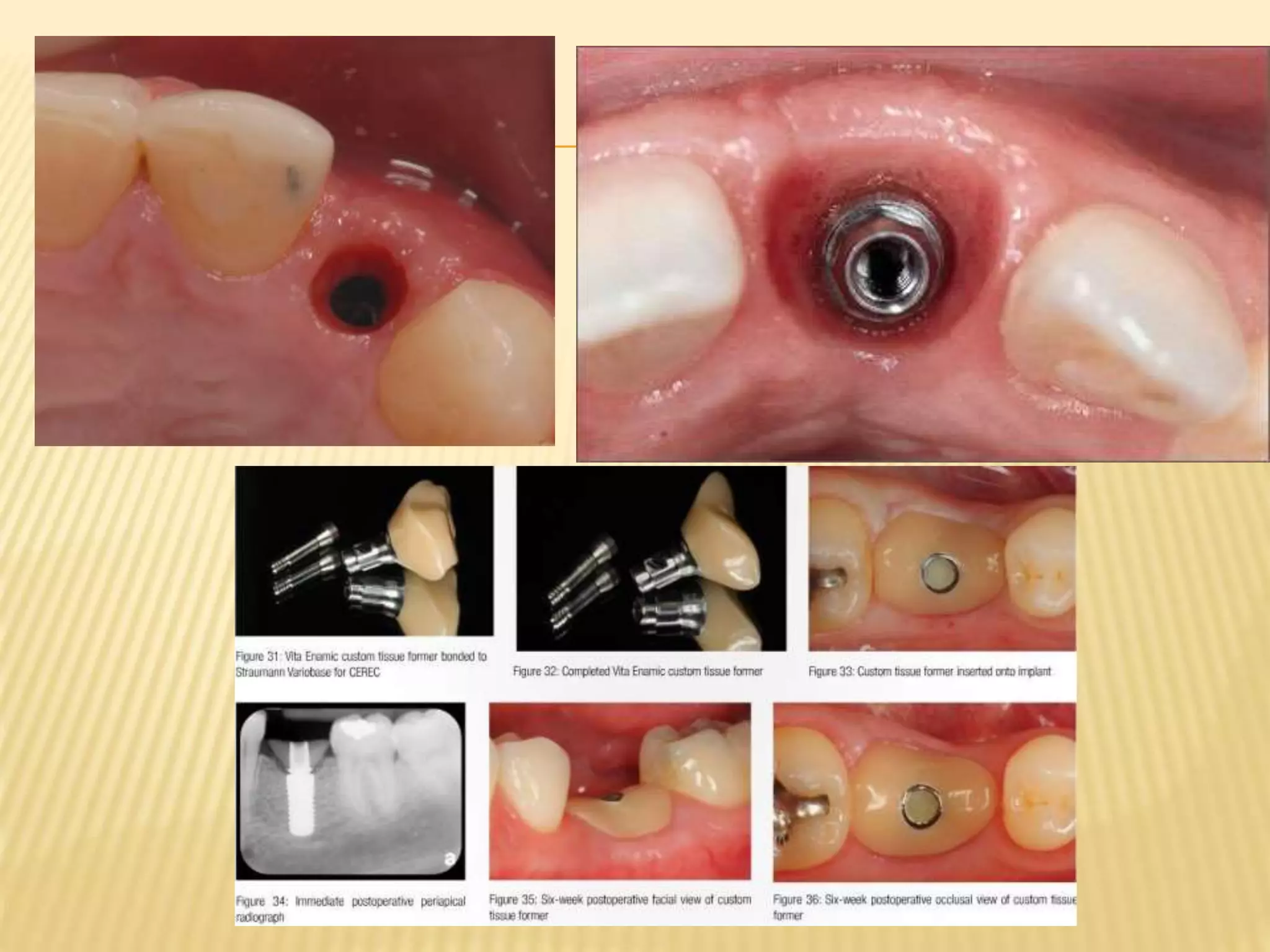 Soft tissue considerations for implant placement | PPTX