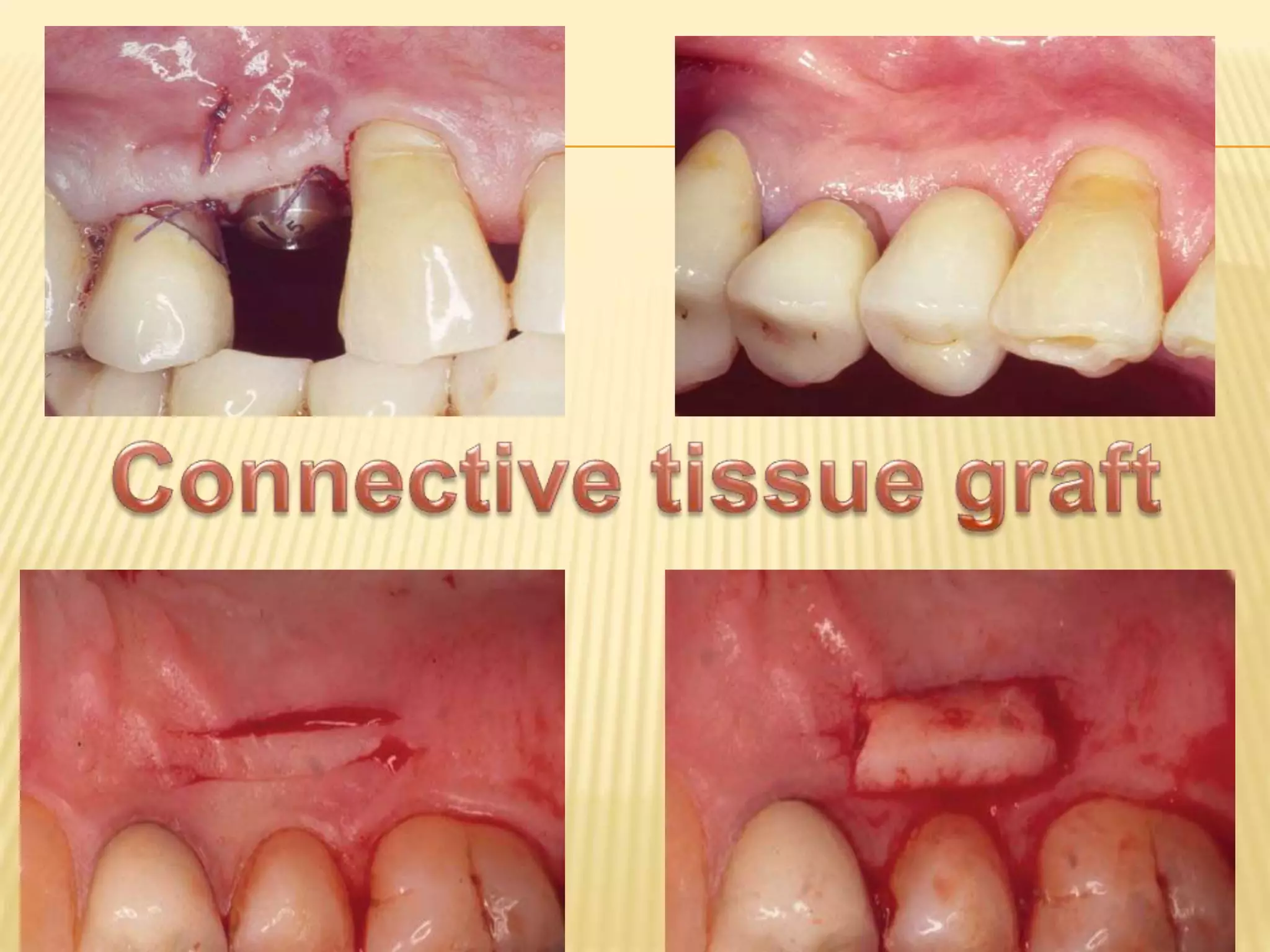 Soft tissue considerations for implant placement | PPTX