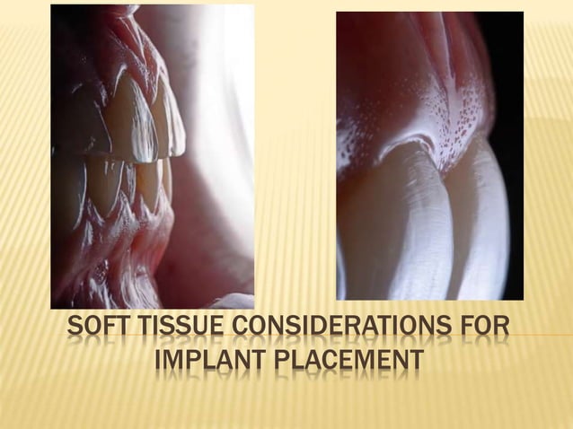 Soft tissue considerations for implant placement | PPTX | Dental Health ...