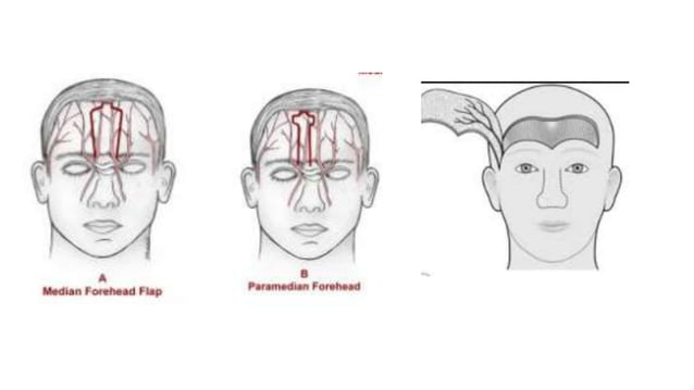 Soft tissue flaps | PPTX