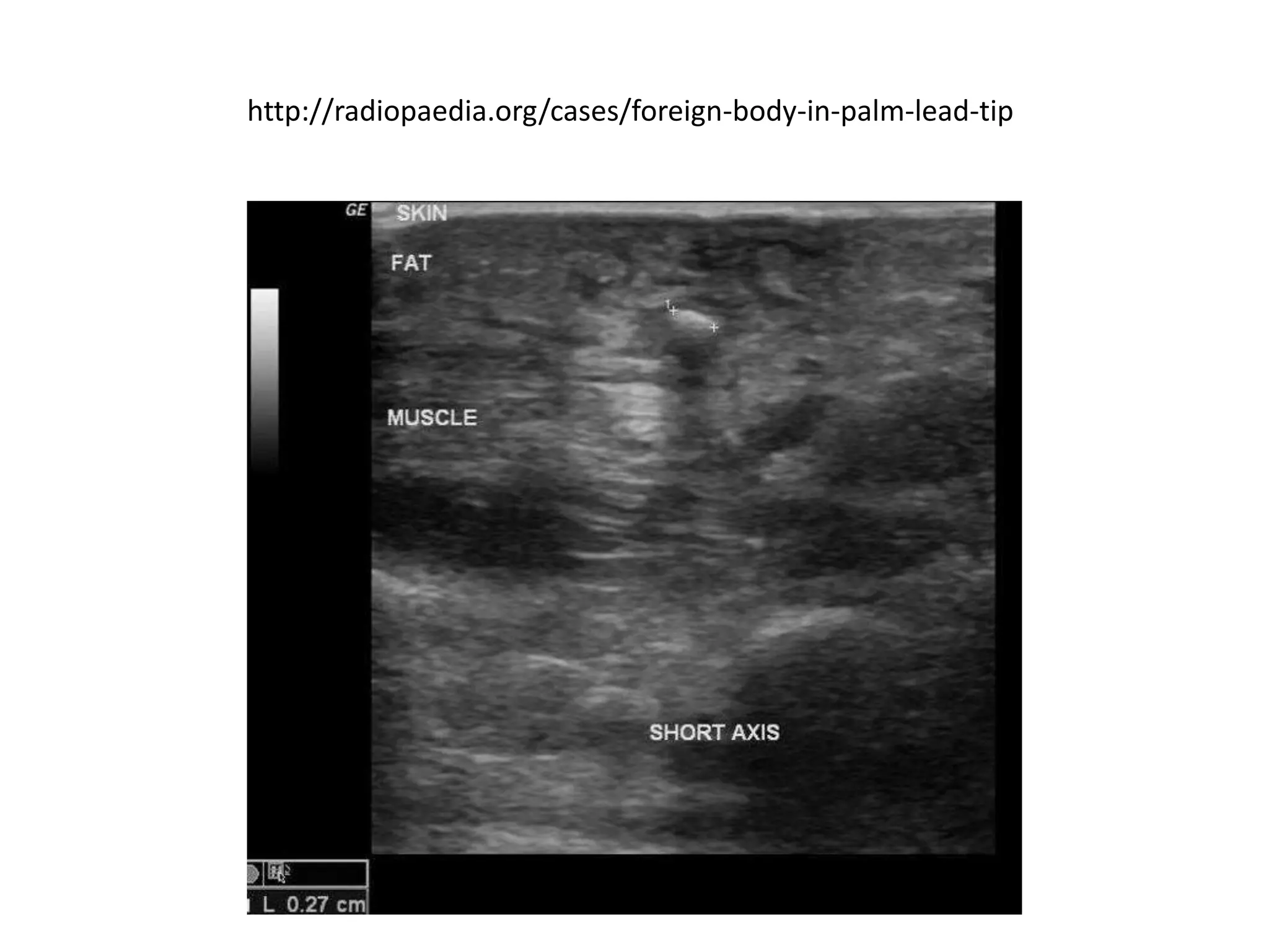 Soft tissue foreign body | PPTX