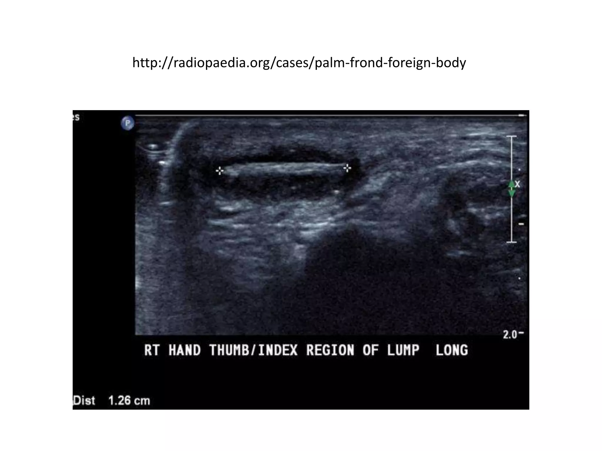Soft tissue foreign body | PPTX
