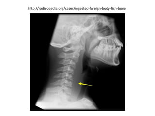 Soft tissue foreign body | PPTX