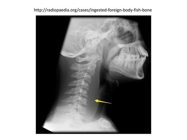 Soft tissue foreign body | PPTX | Death, Injury, or Military Conflict ...