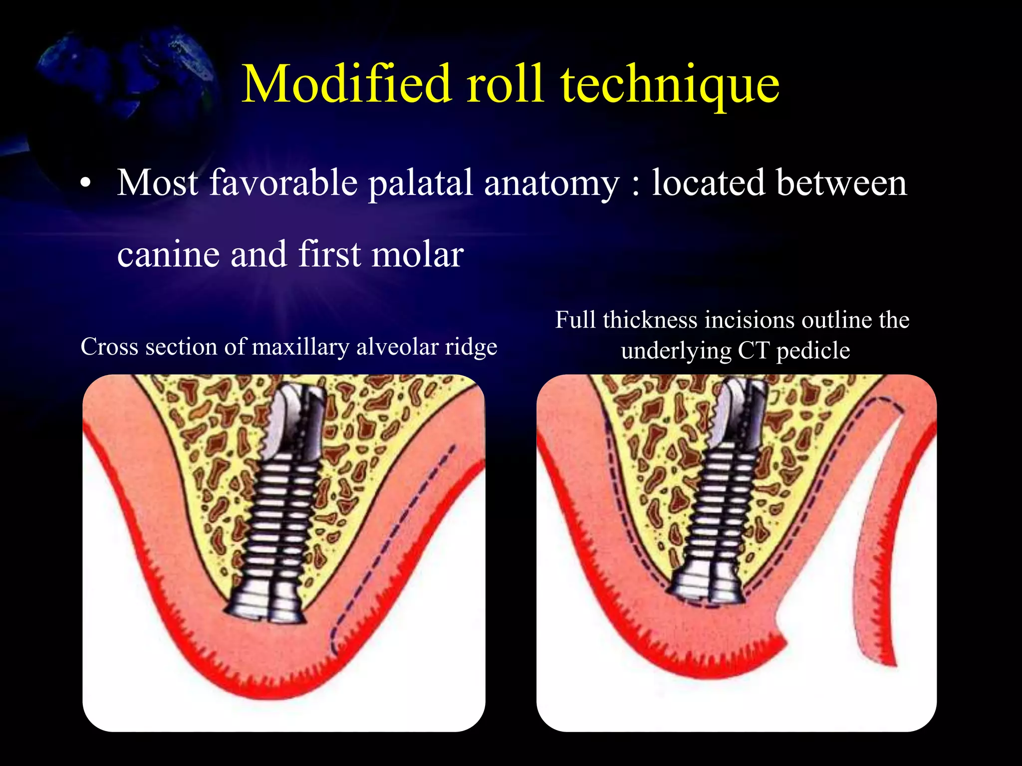 Soft tissue grafting around implants | PPTX