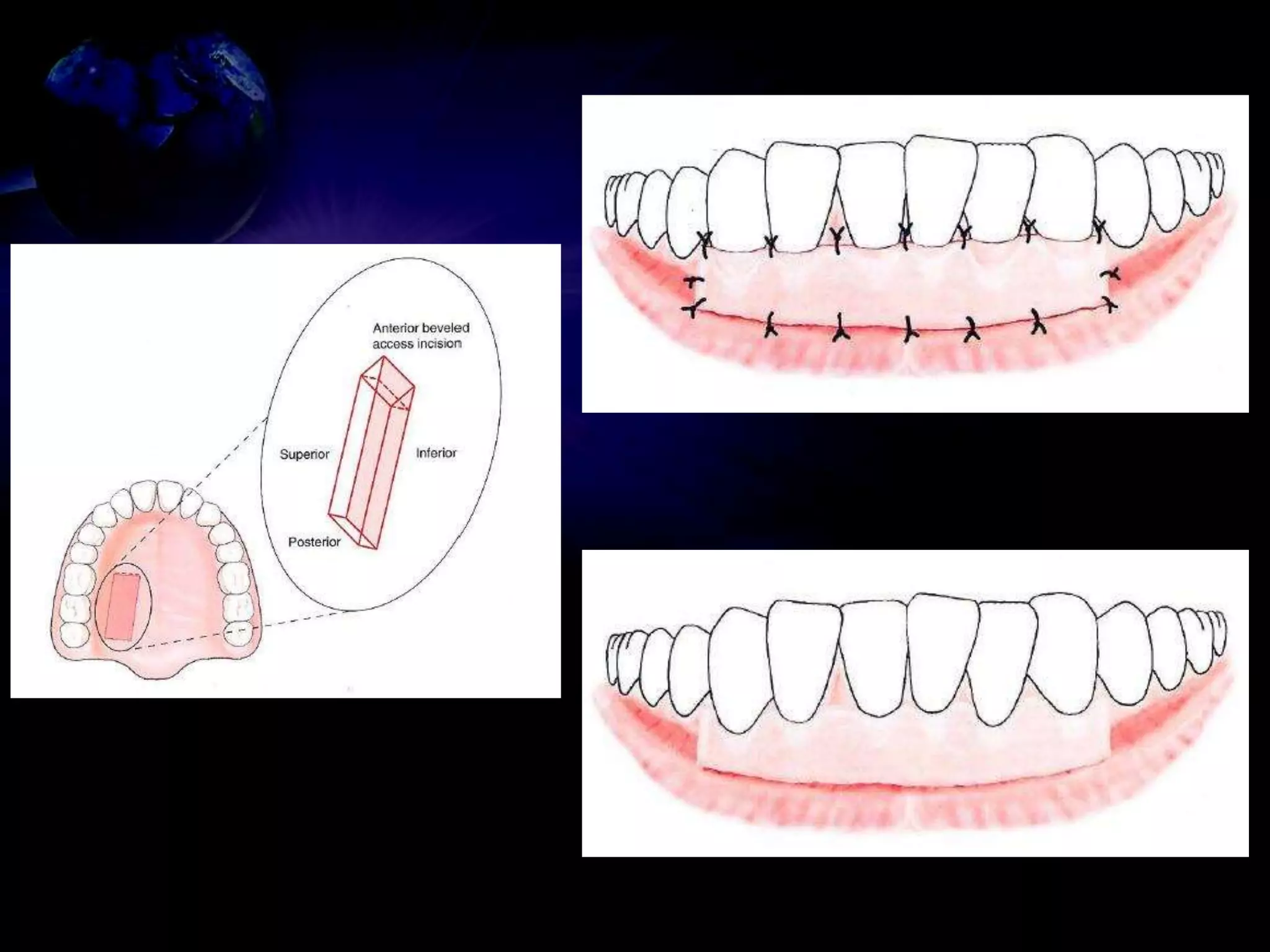 Soft tissue grafting around implants | PPTX
