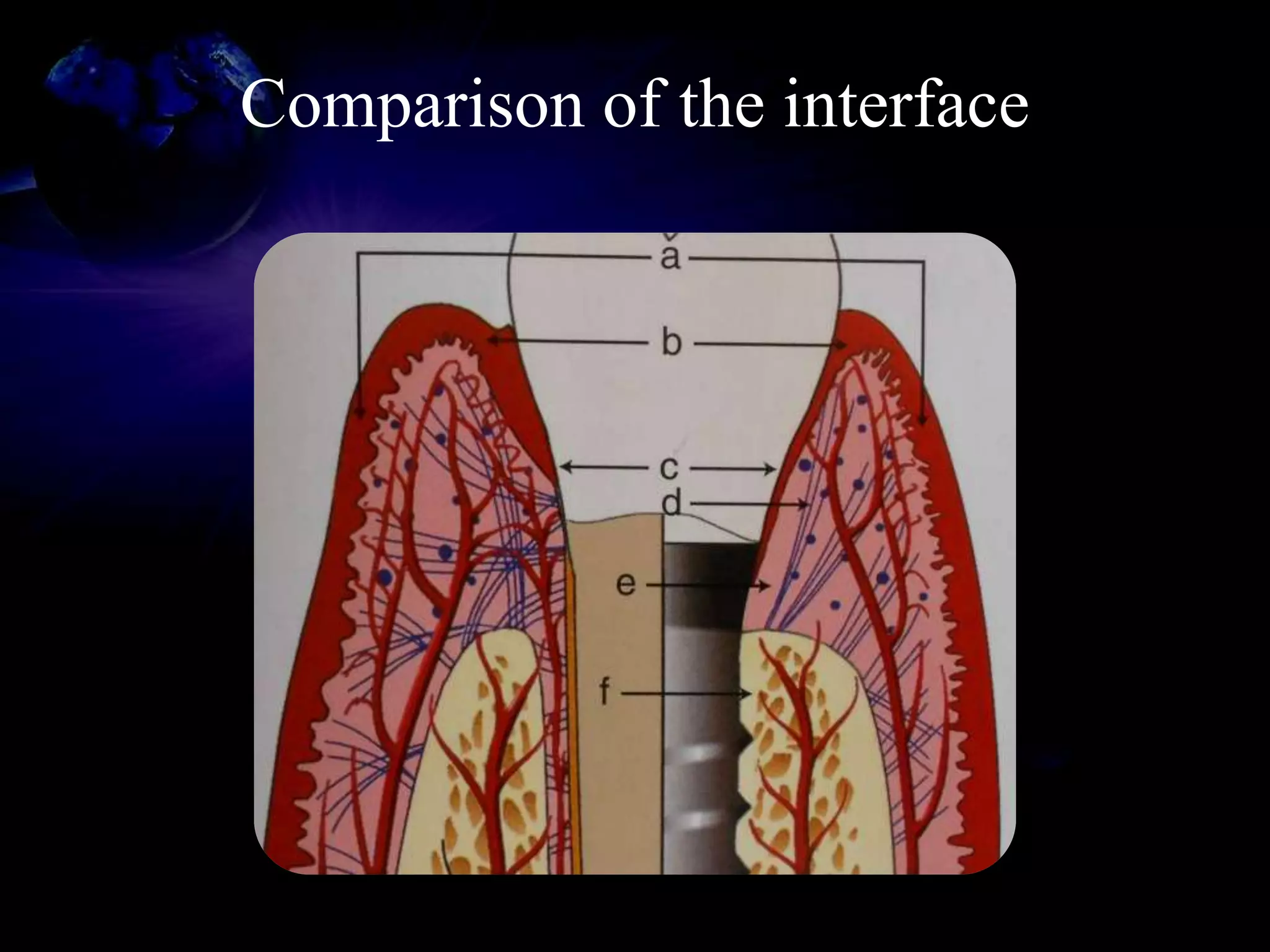 Soft tissue grafting around implants | PPTX