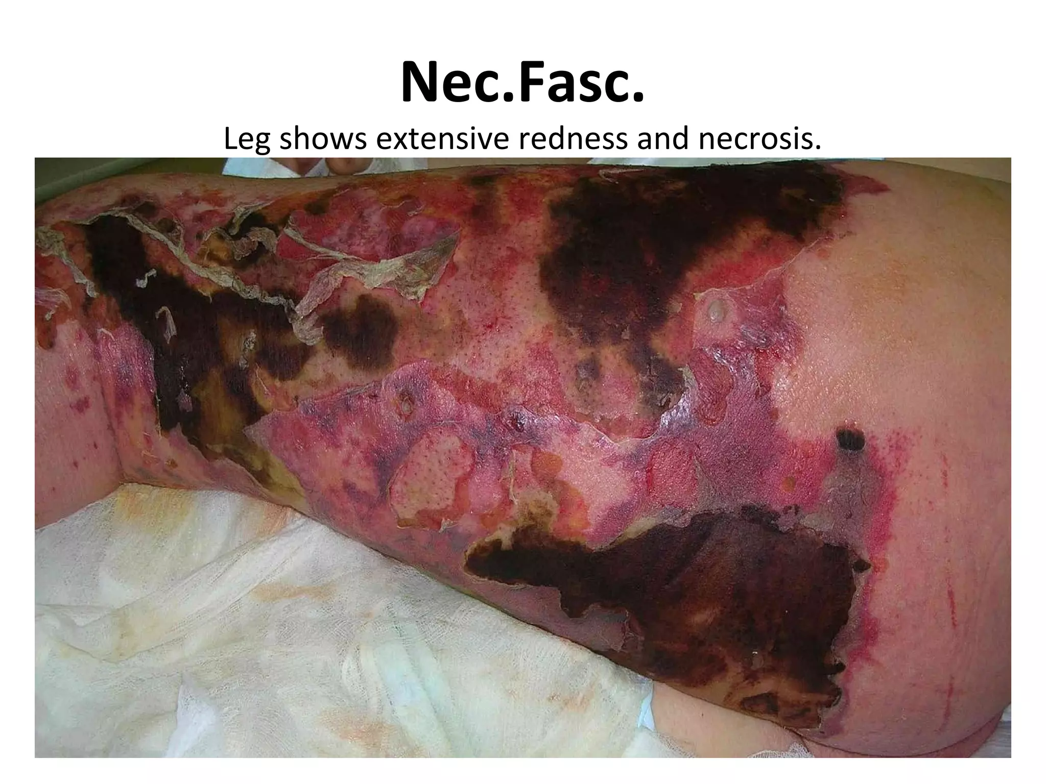 Soft tissue infections surgery | PPT