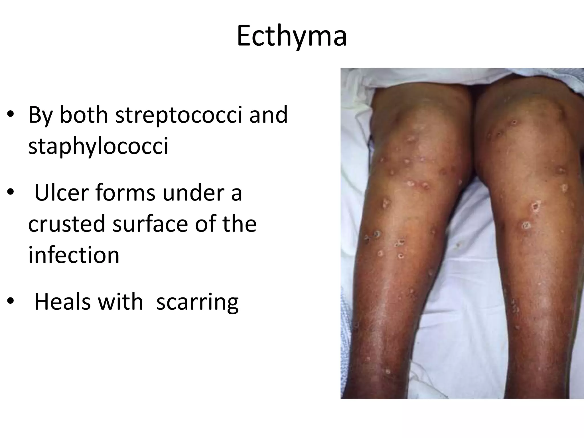 Skin and Soft tissue infections | PPTX