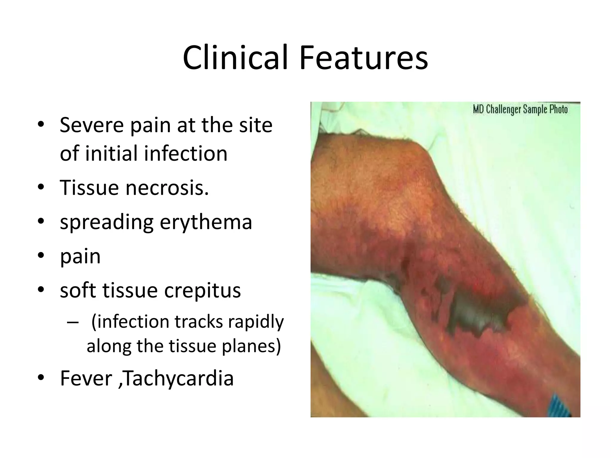 Skin and Soft tissue infections | PPTX