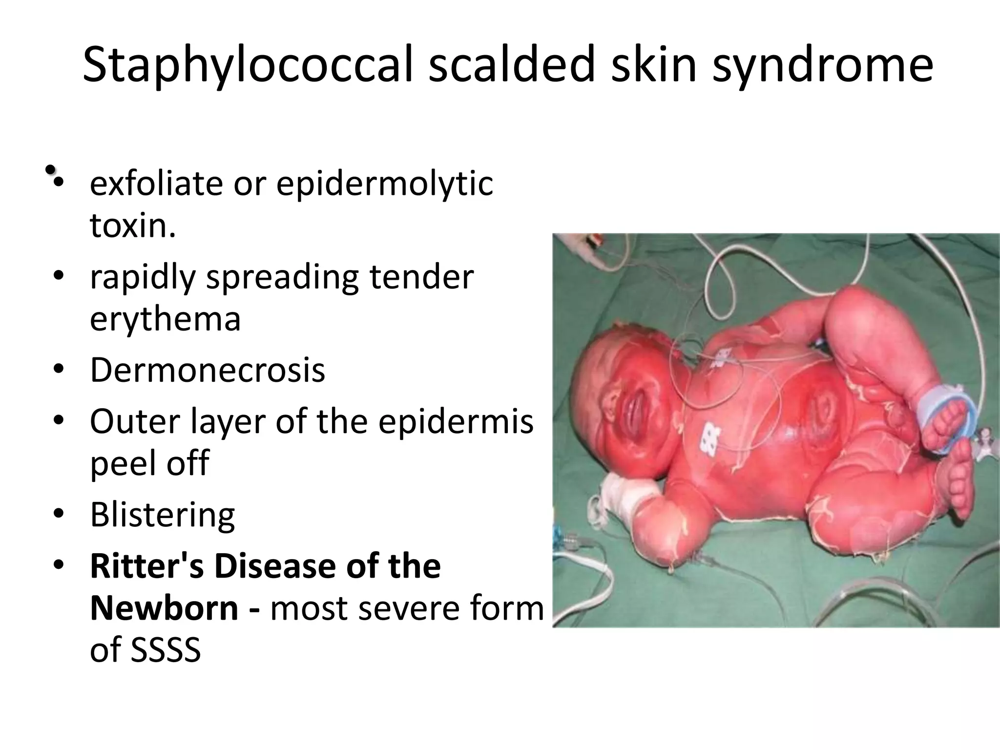 Skin and Soft tissue infections | PPTX