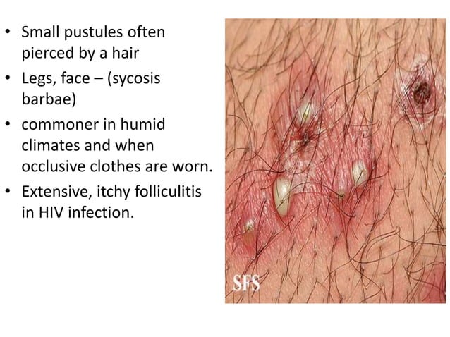 Skin and Soft tissue infections | PPTX | Skin and Dermatology | Diseases and Conditions