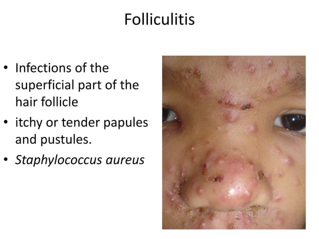 Skin And Soft Tissue Infections