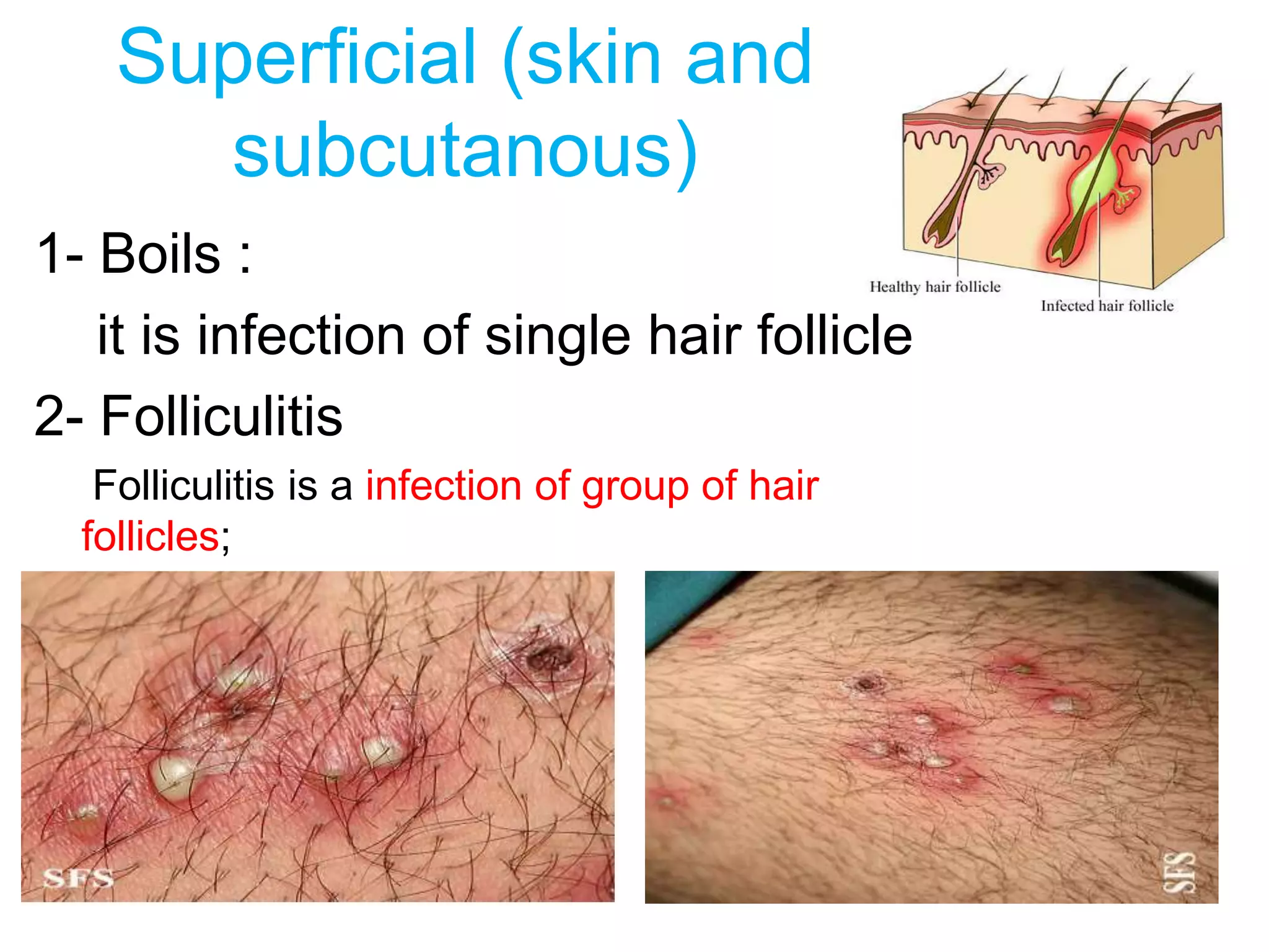 Soft tissue infections (3).ppt