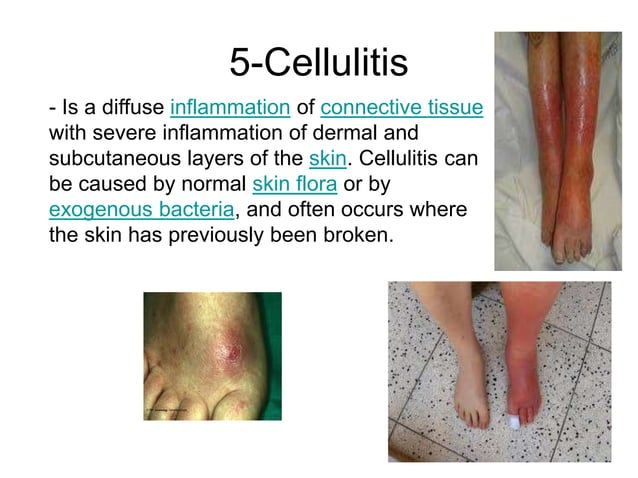 Soft tissue infections (3).ppt