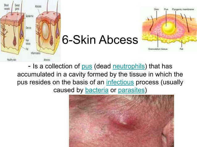 Soft tissue infections (3).ppt