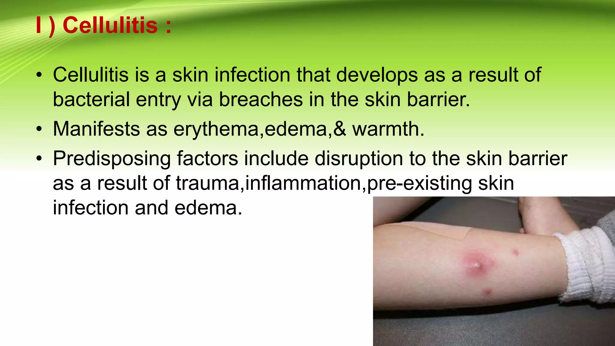 Soft tissue infections in children | PPTX