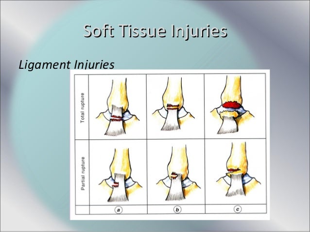 Soft tissue injuries