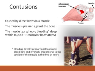 Soft tissue injuries - Muscles , ligaments and tendon injuries | PPTX
