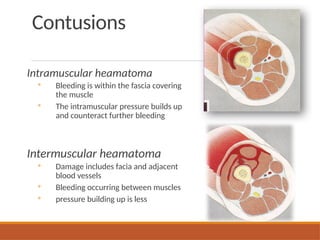 Soft tissue injuries - Muscles , ligaments and tendon injuries | PPTX