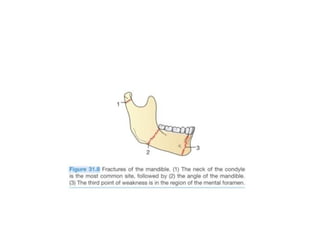 Soft_Tissue_Injuries_and_Mandibular_Fracture.pptx