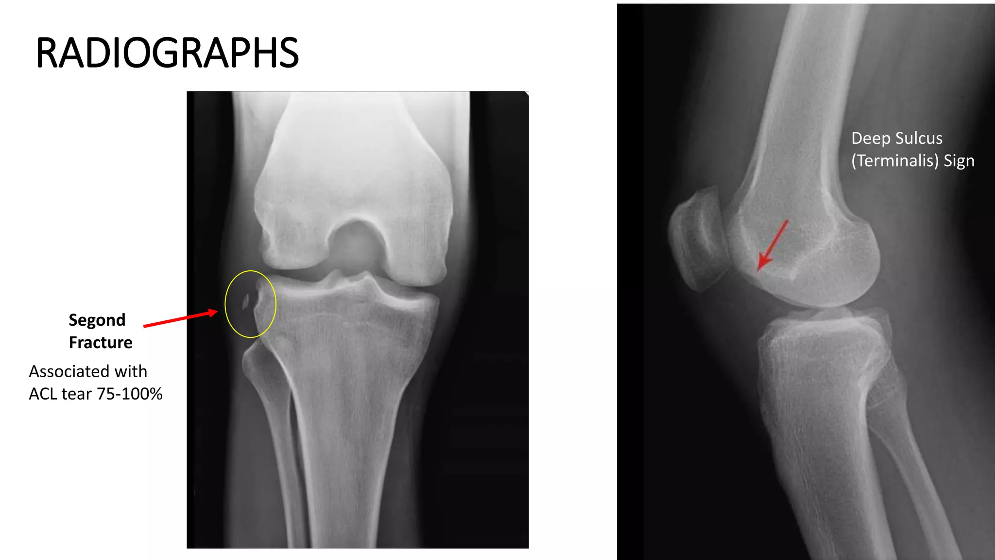 Soft tissue Injuries Knee Joint.pptx
