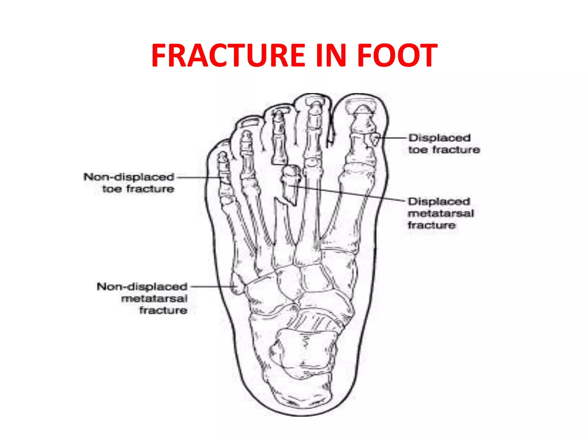Soft Tissue Injuries of Ankle & Foot.pptx