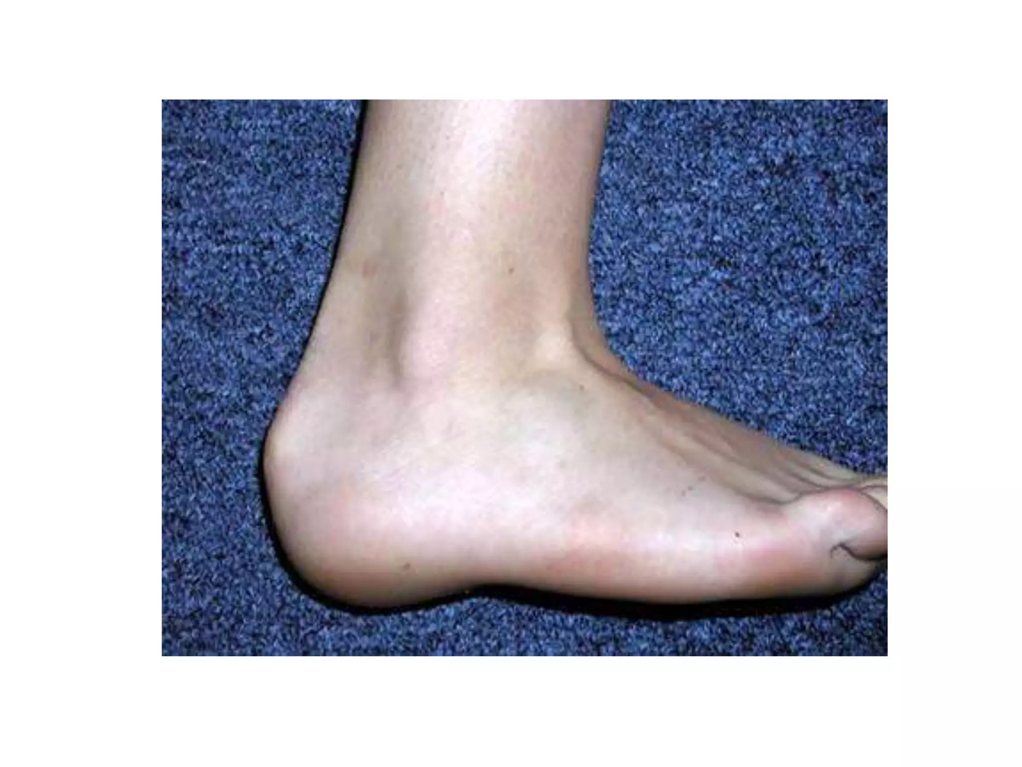 Soft Tissue Injuries of Ankle & Foot.pptx