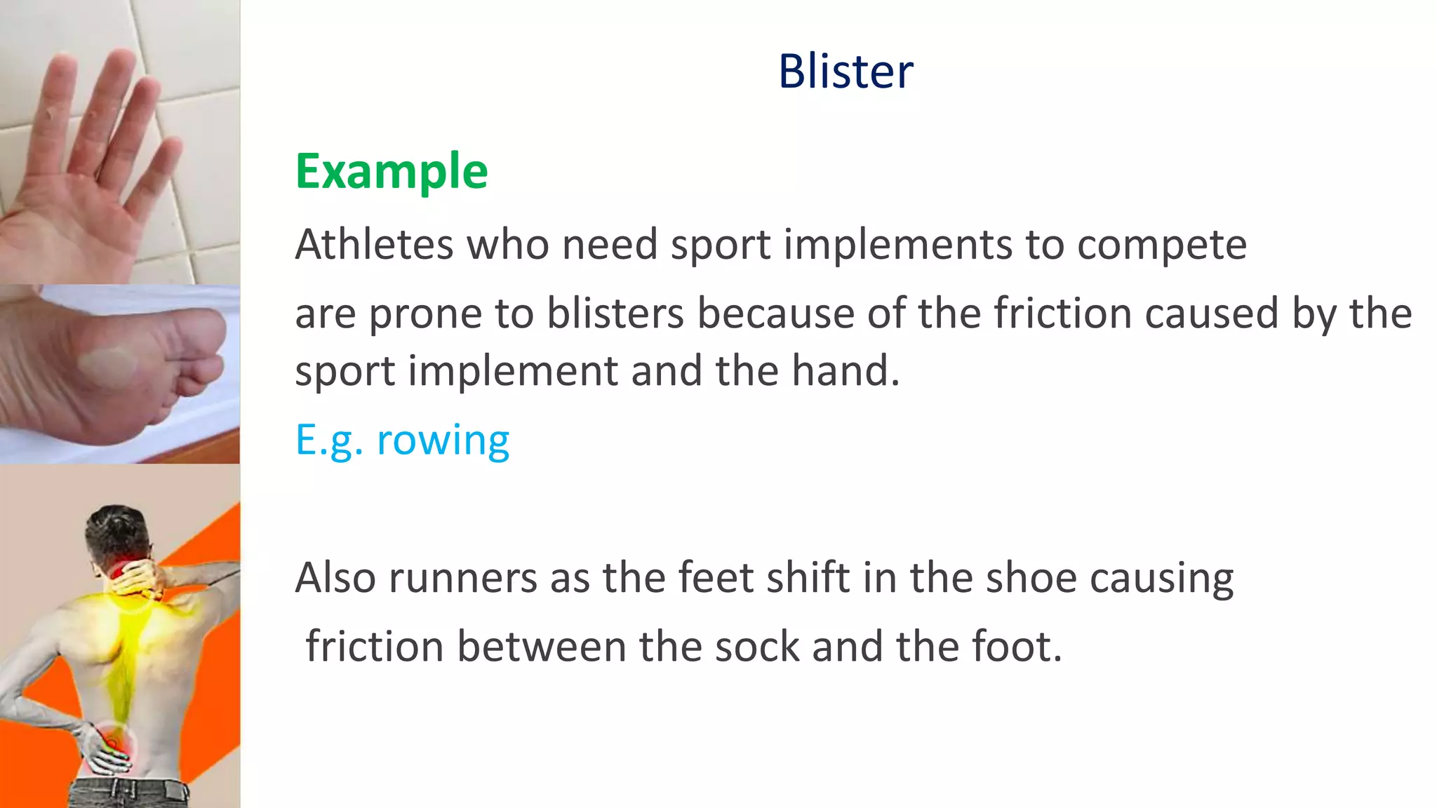 Soft tissue injuries management | PPTX