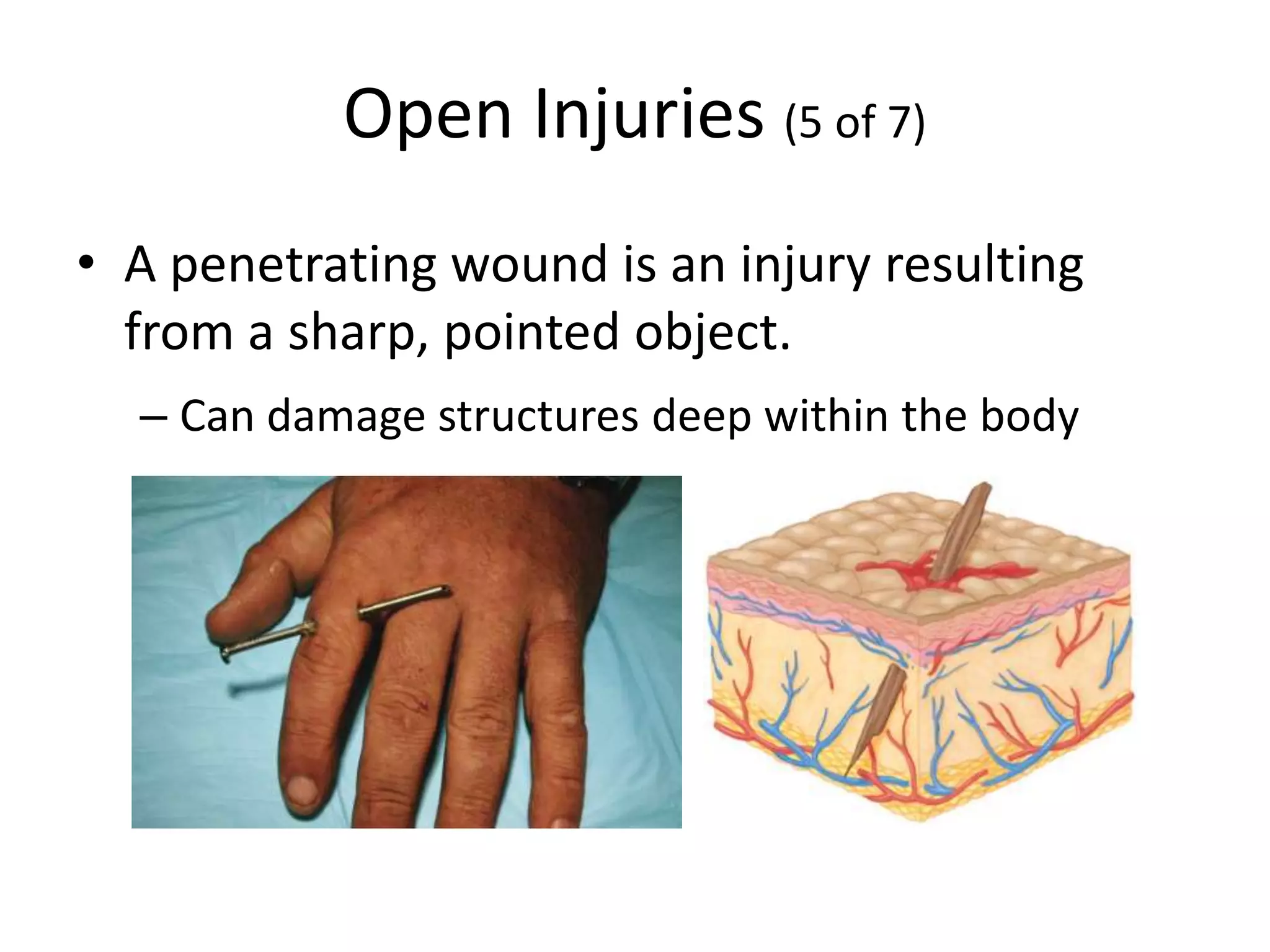 soft tissue injury.pptx