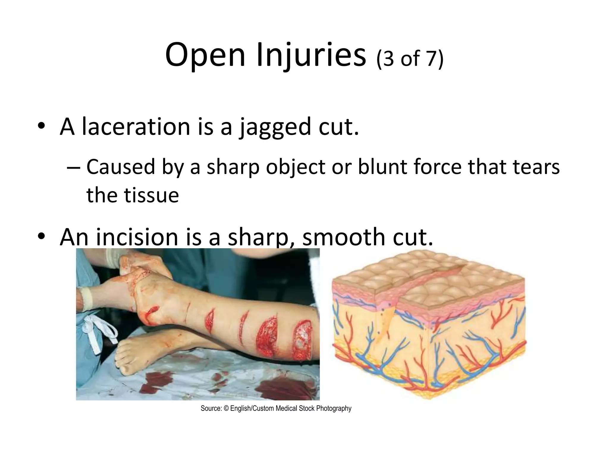 soft tissue injury.pptx