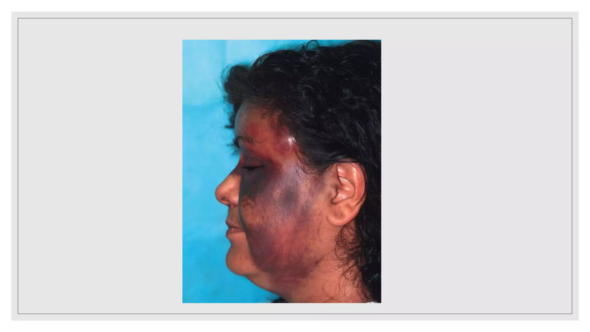 Soft tissue injury in Maxillofacial Trauma | PPTX