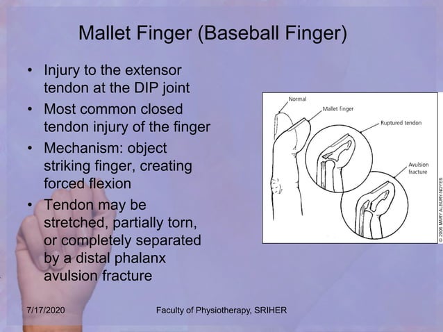 Soft tissue lesion hand | PPTX