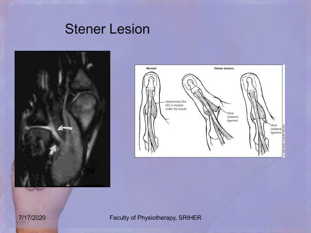 Soft tissue lesion hand | PPTX