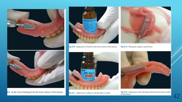 soft tissue liners and tissue conditioners - Copy.pptx | Dental Health ...