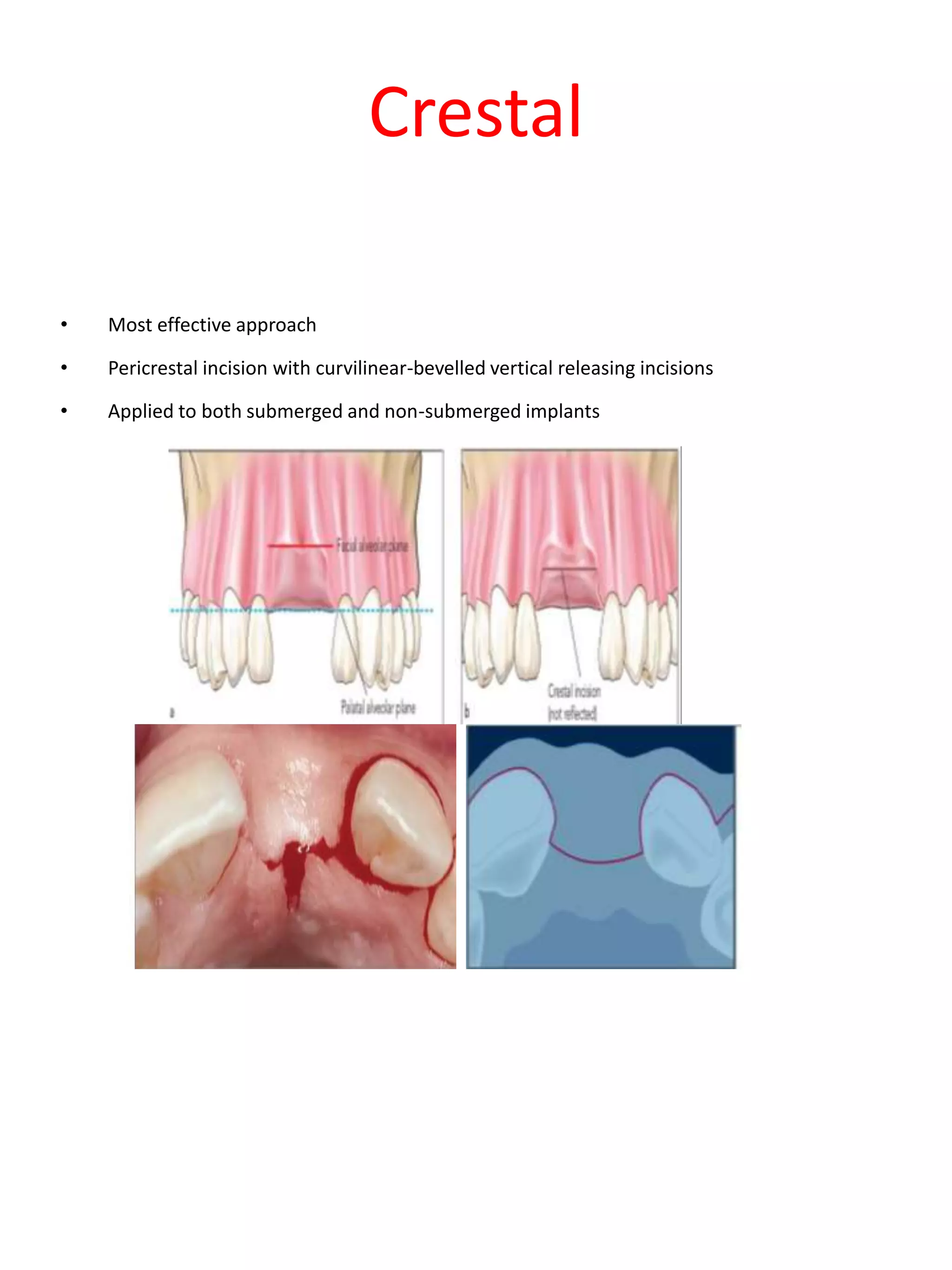Soft tissue management around dental implant | PPTX