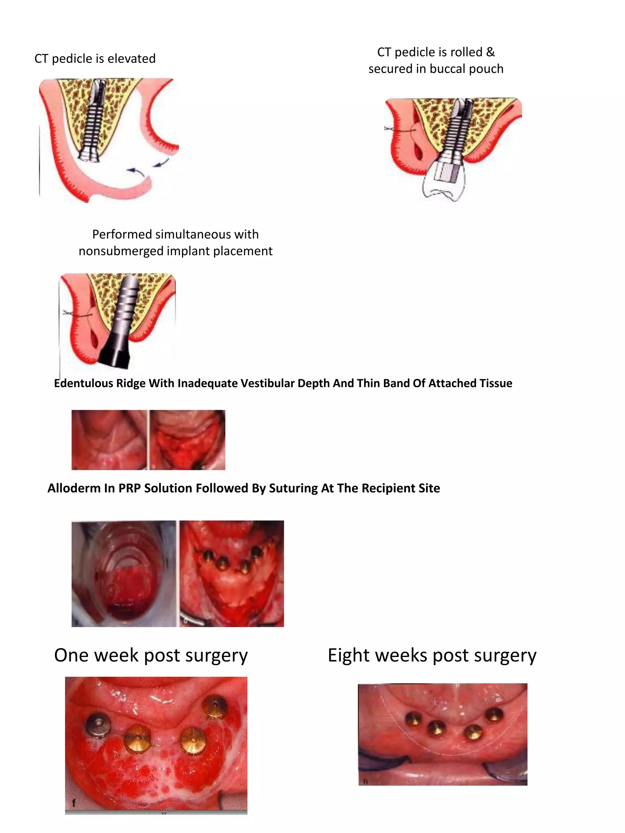 Soft tissue management around dental implant | PPTX