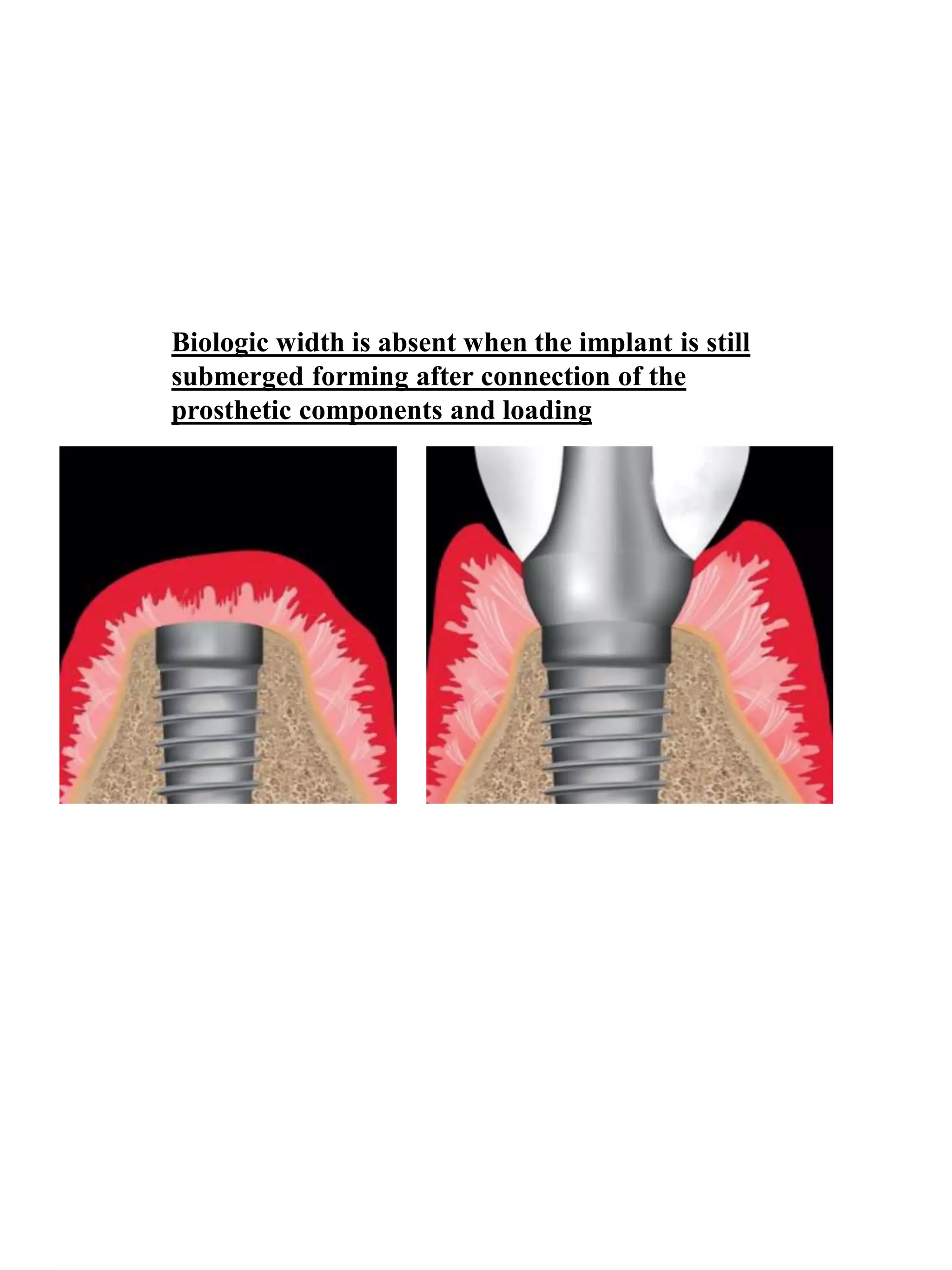 Soft tissue management around dental implant | PPTX
